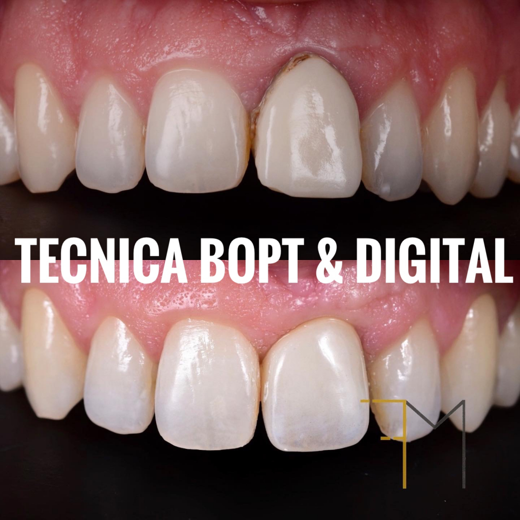 Corona Zirconio con Tecnica BOPT para diente discromico