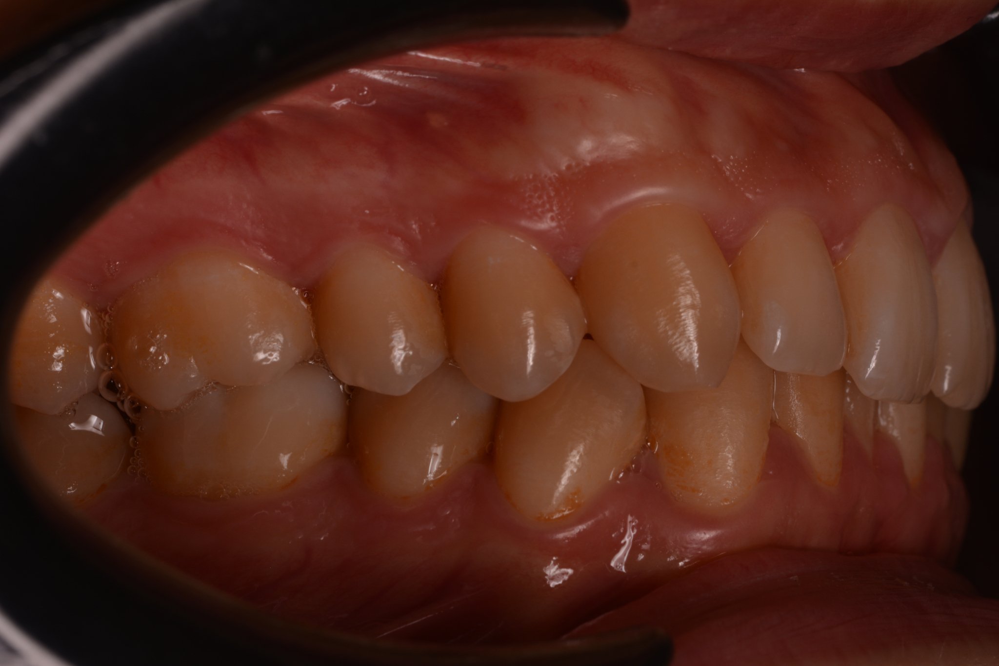 ¿Que flash comprar? Guía a los FLASHES en ODONTOLOGÍA