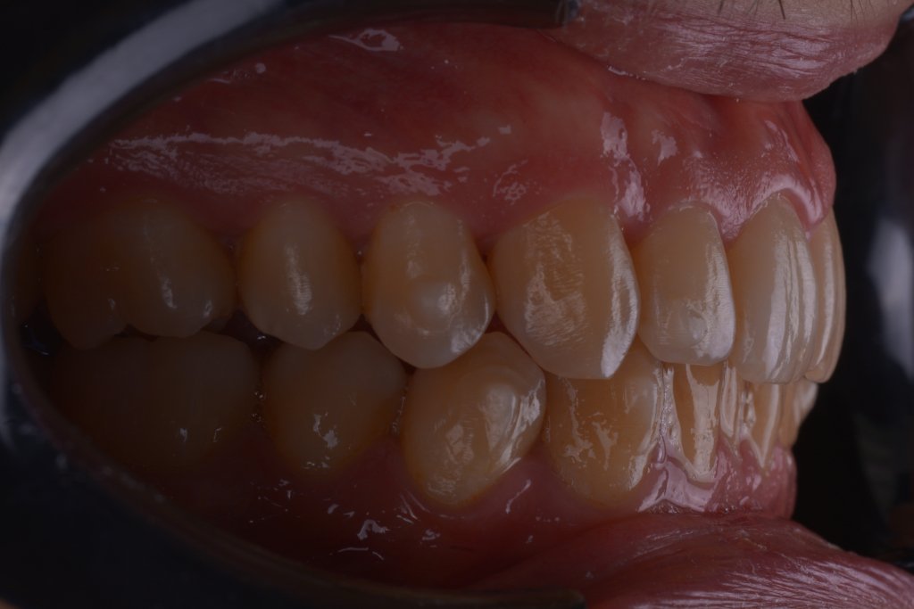 ¿Que flash comprar? Guía a los FLASHES en ODONTOLOGÍA
