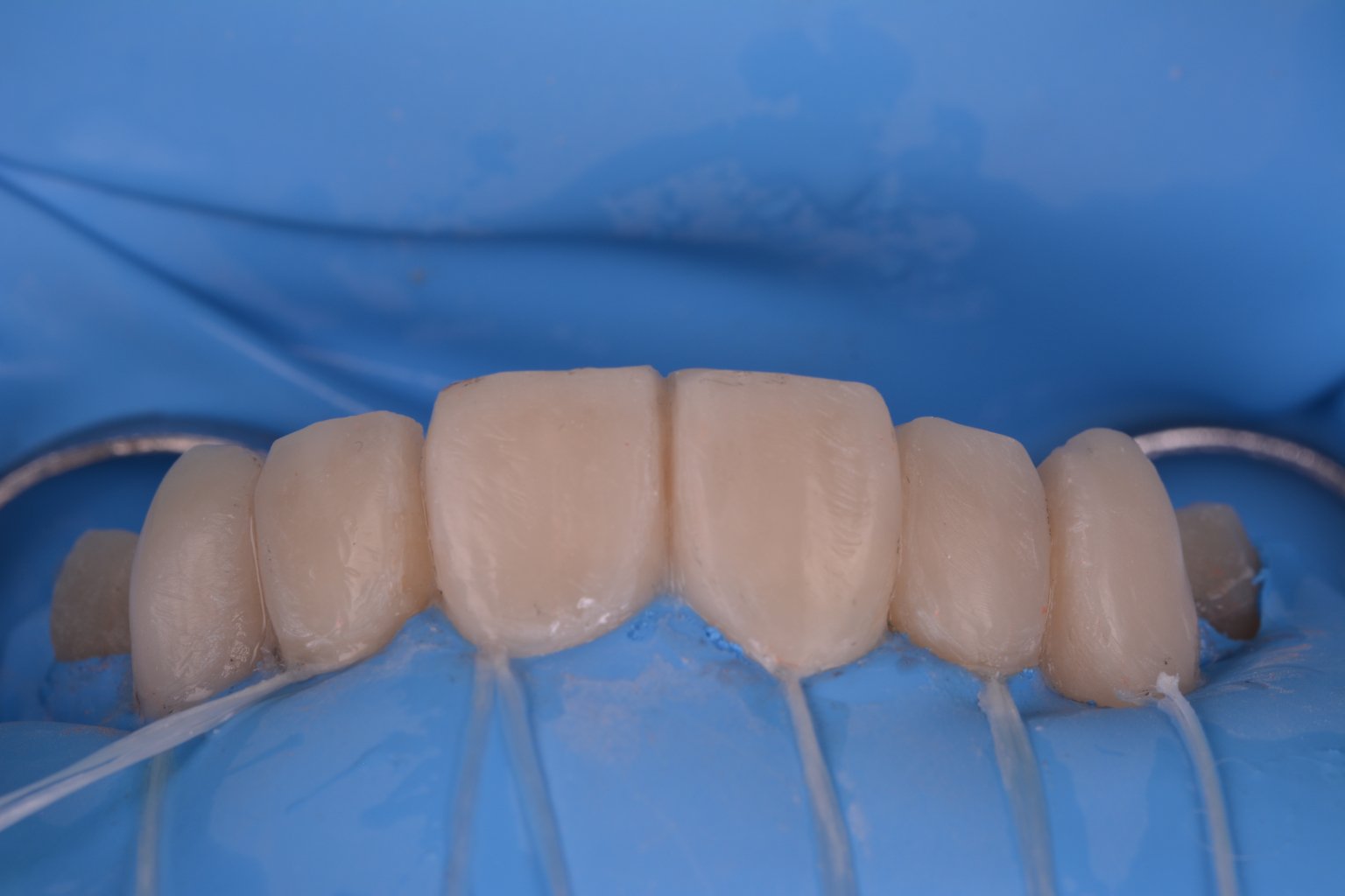 TECNÍCA COMPOSITE INYECTADO para CARILLAS DENTALES ¿PORQUE NO? Estética ...